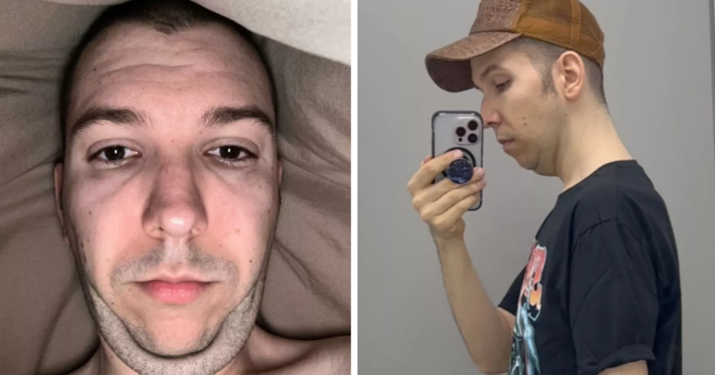 Nikocado Avocado has undergone major plastic surgery following weight loss