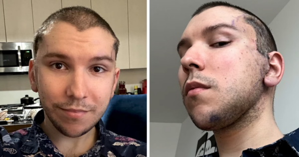 Nikocado Avocado has undergone major plastic surgery following weight loss