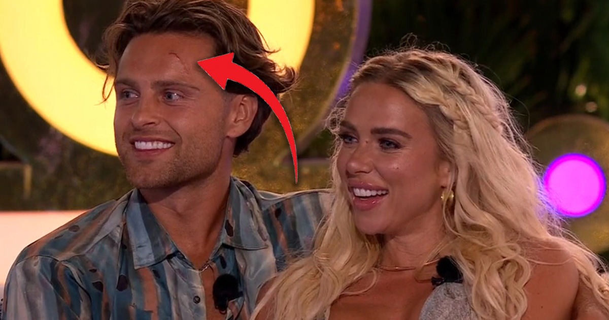Reason Casey had cut on his head for Love Island All Stars final