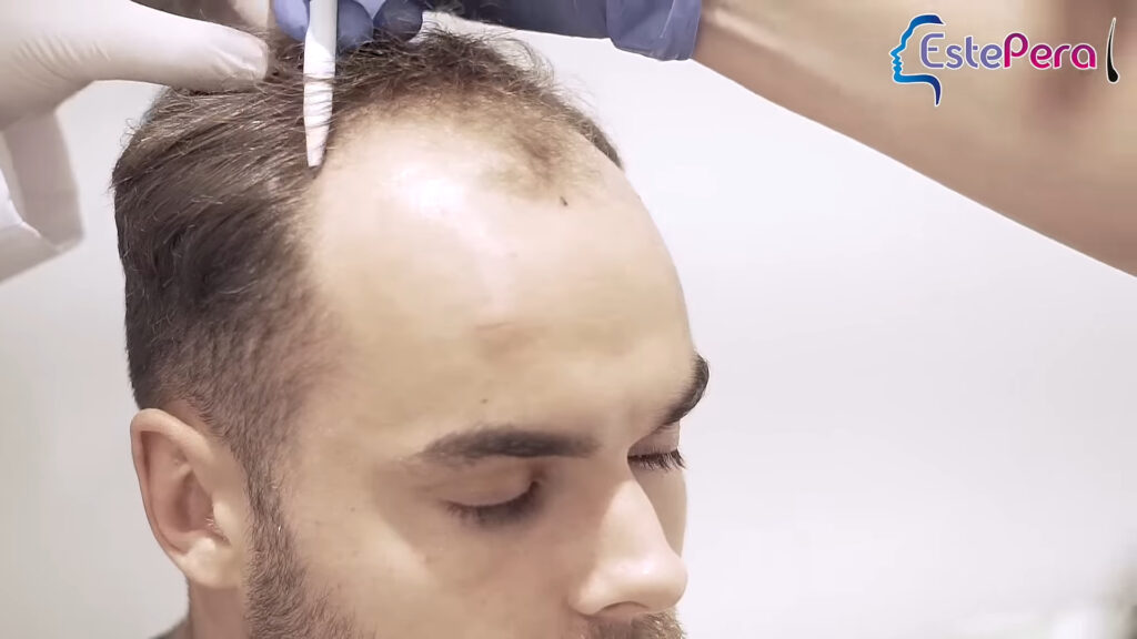 Full video of Harry getting Turkey hair transplant before Love Island