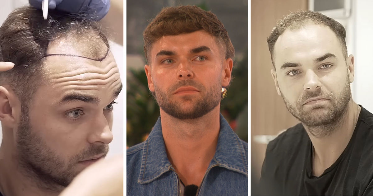 Full video of Harry getting Turkey hair transplant before Love Island