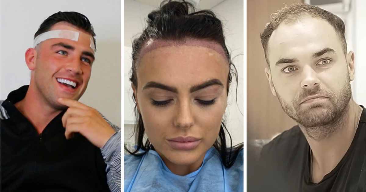 Every Love Island cast member who's had a hair transplant