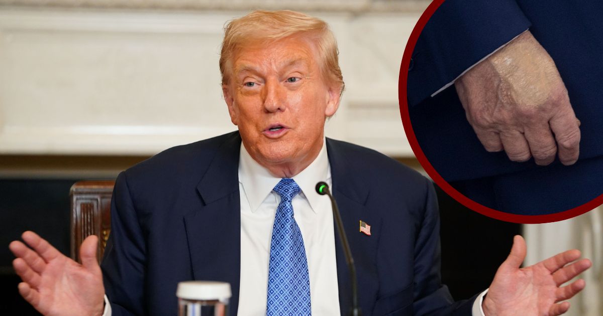 Doctor reveals likely reason for Donald Trump's hand bruise